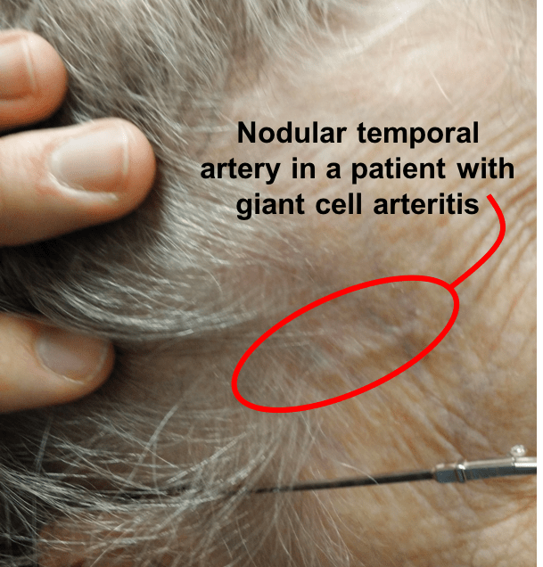 Giant Cell Arteritis Neuro Ophthalmology